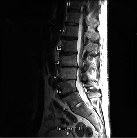 Sagittal Section Of Lumbar Spine Showing Discitis And Osteomyelitis At Download Scientific