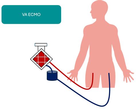 Extracorporele Membraanoxygenatie Ecmo Uza