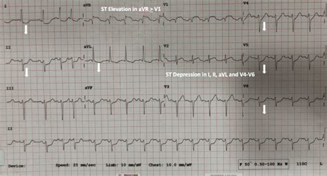 St Elevation In Avr Emergency Medicine Education Resus