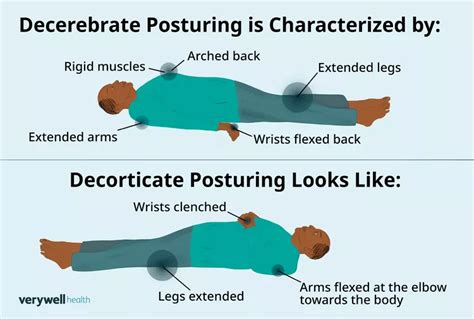 Decorticate Vs Decerebrate Posturing Which Is Which