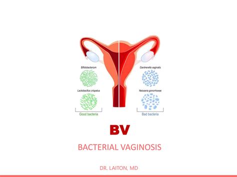 Bacterial Vaginosispptx