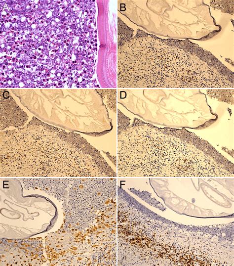 A Suppurative Granulomas Consisted Of Macrophages Epithelioid Cells Download Scientific