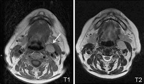 Example Of A Metastatic T1 Hyperintense Left Level Ii Lymph Node