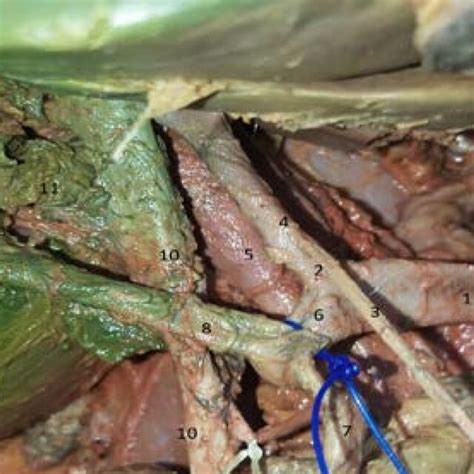 Common Hepatic Artery Branches 1 Common Hepatic Artery 2