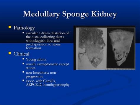 Cystic Renal Disease