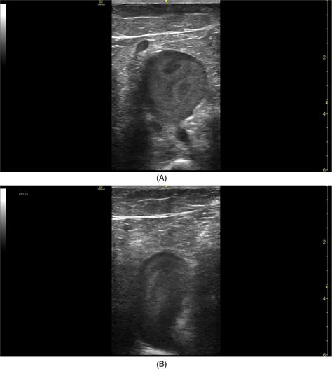 Ultrasound Of The Left Leg Demonstrating An Enlargement Of The