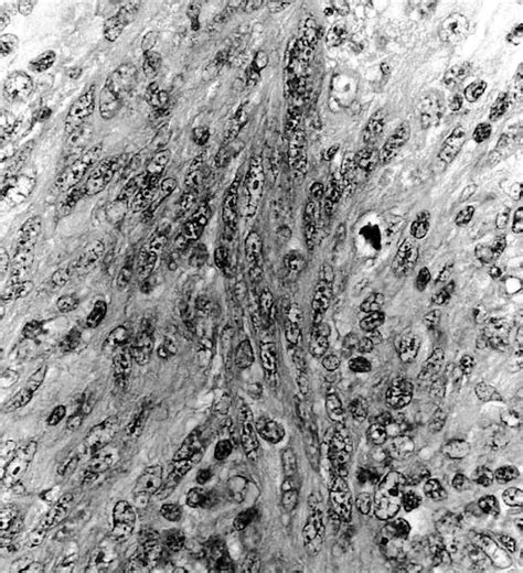 Pathology Outlines Interdigitating Dendritic Cell Tumor