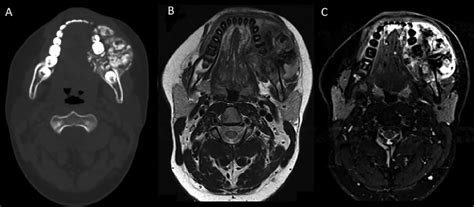 A Axial Ct Head Shows Progressive Disease With Increased Download Scientific Diagram