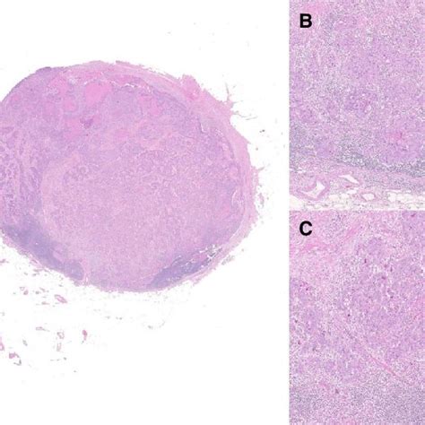 A The Lymph Node Architecture Is Distorted By This Multinodular Download Scientific Diagram
