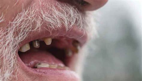 Tooth Loss Appears To Affect Cognitive Decline Among Older Adults
