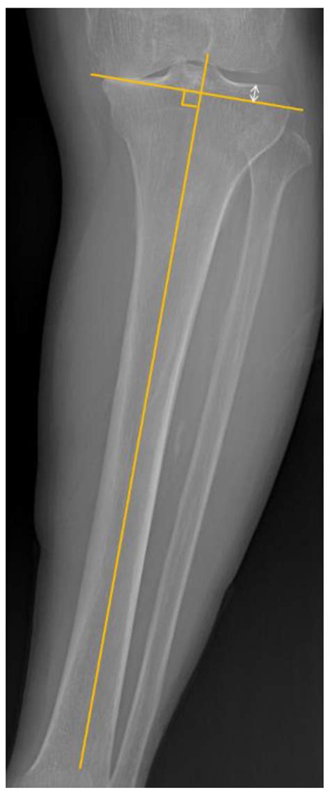 Accuracy Of The Tibial Component Alignment By Extramedullary System