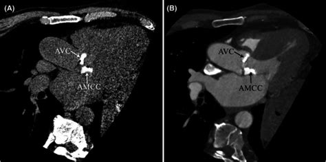 Association Between Aortomitral Continuity Calcification And Conduction Disturbances Following