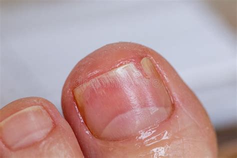 Applying Anti Fungus Medicine To Big Toe Stock Image Image Of