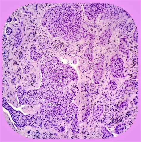 Héctor Enrique Torres Rivas On Linkedin 🩺 Medical Record Palatine Tonsil Squamous Cell