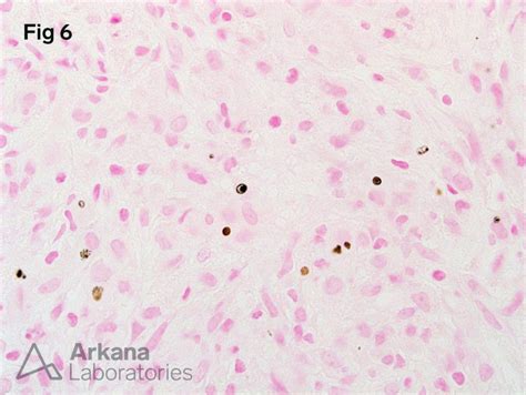 Malakoplakia Teaching Points Arkana Laboratories