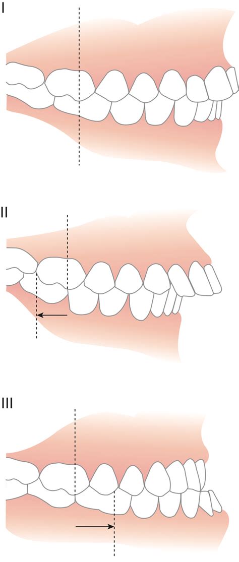 Angles Klassifikation Lex