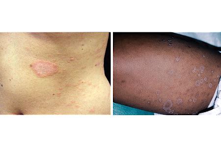 Pityriasis Rosea African American Face Psoriasis On Black Skin