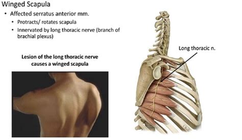 Winged Scapula Serratus Anterior