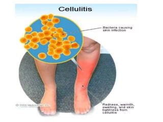 Clinical Approach And Principle Of Management Of Cellulitis And