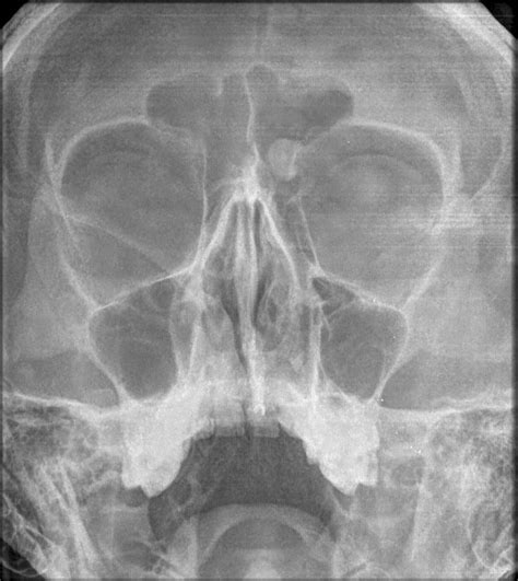 Paranasal Sinuses X Ray