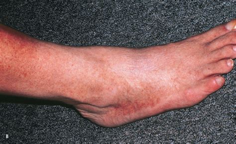 Skin Signs Of Vascular Disorders Consultant360