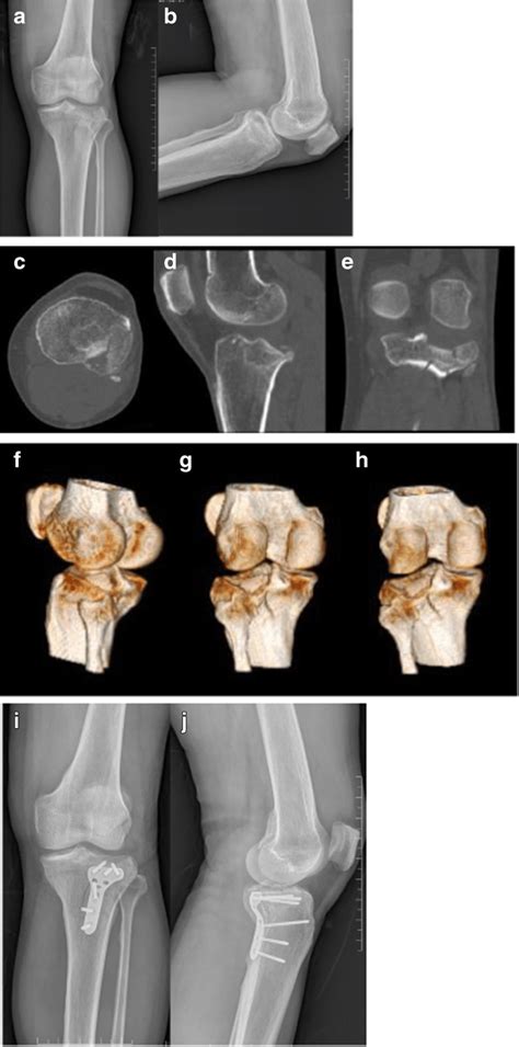 One Male Patient With Posterolateral Tibial Plateau Fracture 43y