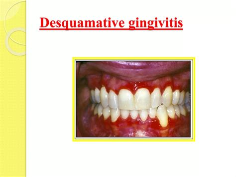 Desquamative Gingivitis Diagnosis And Management Pptx