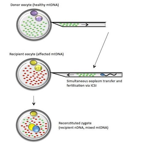 Ooplasmic Transfer Donor Ooplasm Is Transferred To A Recipient Oocyte