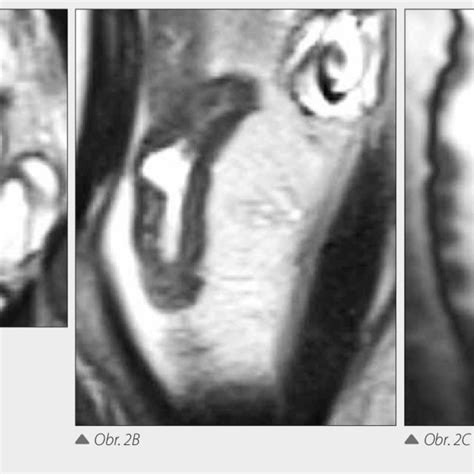 Montreal Classification For Cd Download Table