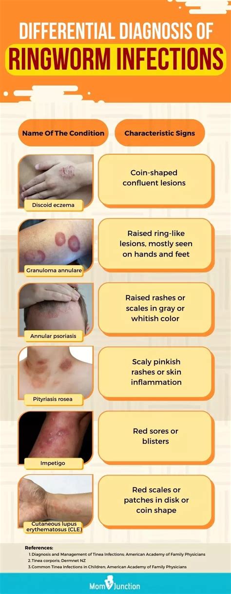 Ringworm Signs And Symptoms