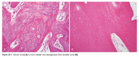 Woven Vs Lamellar Bone Histopathology Of Osteogenesis Imperfecta Bone