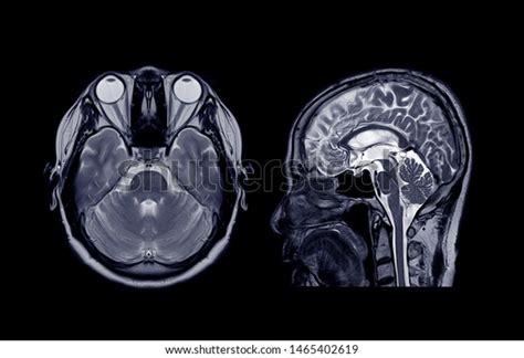 Frontal Plane Mri