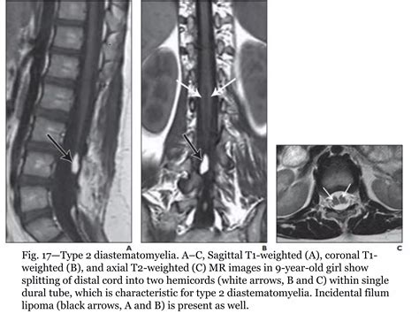Imaging In Spinal Dysraphism Pptx