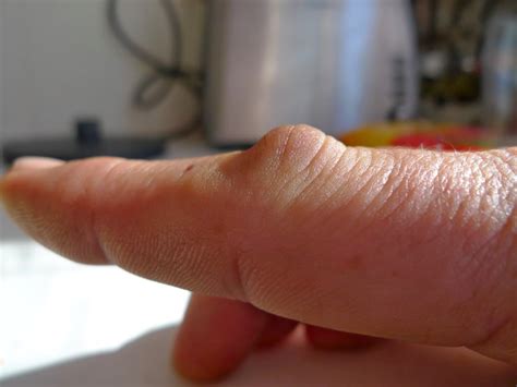 Toms Physiotherapy Blog Fingers Ganglion Cysts