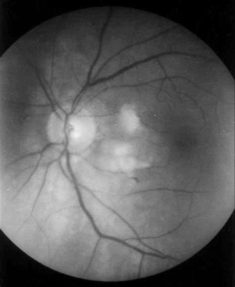 Case 3 Cotton Wool Spots In The Papillomacular Bundle Download Scientific Diagram