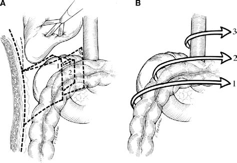Figure 2 From Laparoscopic Transperitoneal Nephrectomy For Renal Cancer