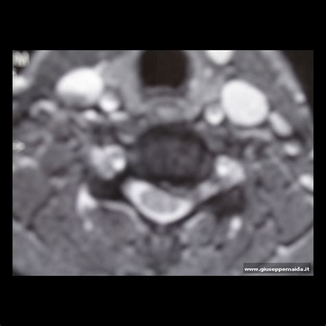 Cervical Disc Herniations Microsurgery And Disc Prosthesis