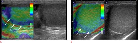 Elastography Of Focal Testicular Lesions Current Concepts And Utility
