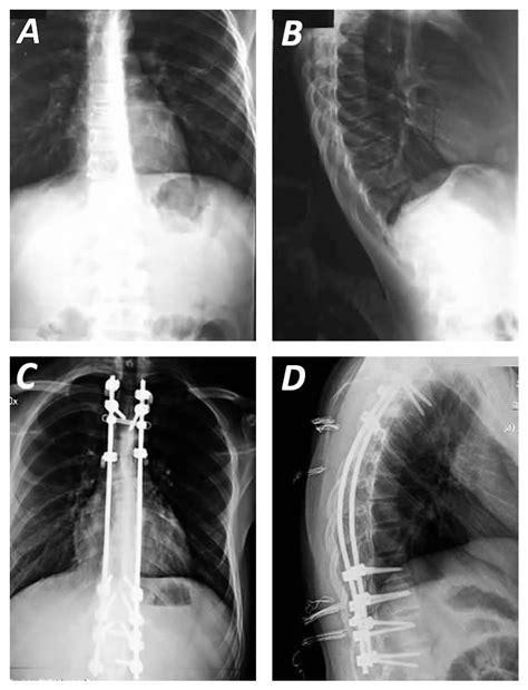 Surgical Strategies And Challenges In Scheuermanns Kyphosis A