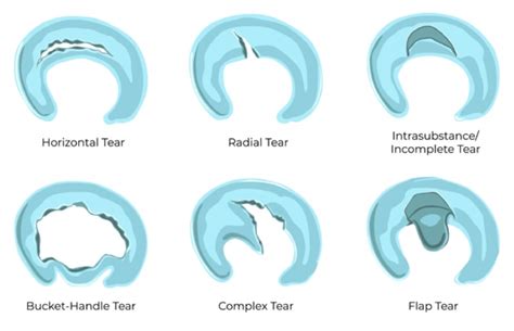 Radial Meniscus Tear Treatment