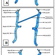 Pdf Persistant Left Superior Vena Cava” Embryological Basis And Its
