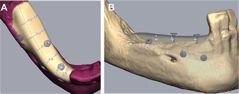 Customized Bone Regeneration For Complex Ridge Defects Using A Patient