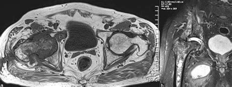 Hydroxyapatite Crystal Deposition Causing Rapidly Destructive