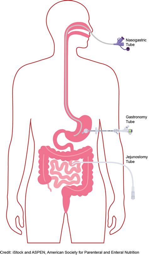 What Is Enteral Nutrition Aspen