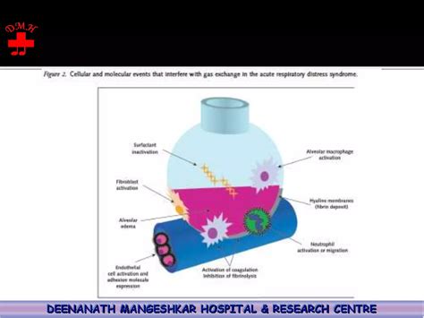 Ards Patho Physiology 1 Pptx