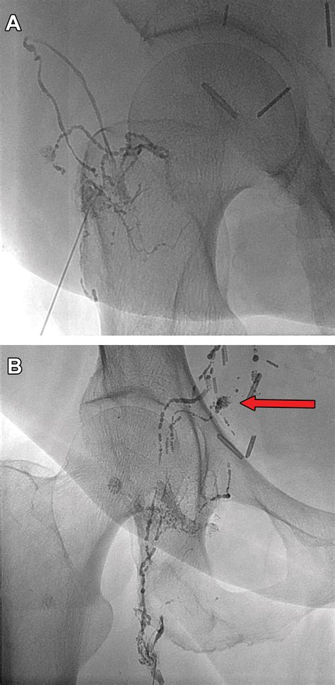Interventional Management Of Acquired Lymphatic Disorders Radiographics