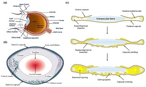 Posterior Capsular Opacification Development At Crystal Molden Blog