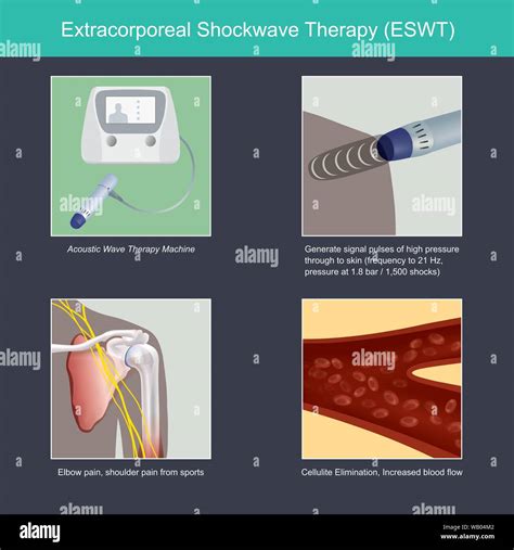 Shockwave Therapy Stock Vector Images Alamy