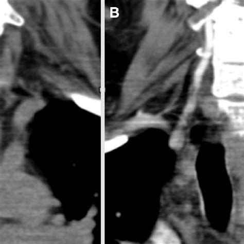 Four Dimensional Computed Tomography Coronal A Precontrast And B