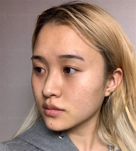 Facial Implants Ab Plastic Surgery